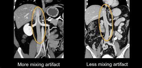Abdominal CT Abdominal Veins LITFL Radiology Library