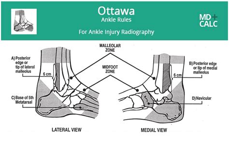 A Guide To Ankle Sprains Hurst Podiatry