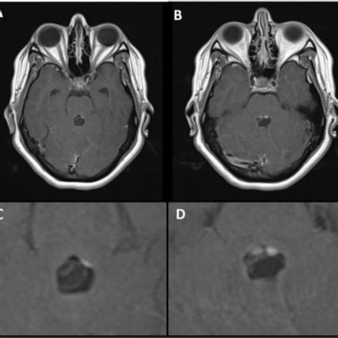 Higher Magnification Of Preoperative Magnetic Resonance Imaging MRI