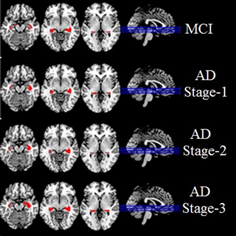 classification of alzheimer s disease stages an approach using pca based algorithm fayyaz