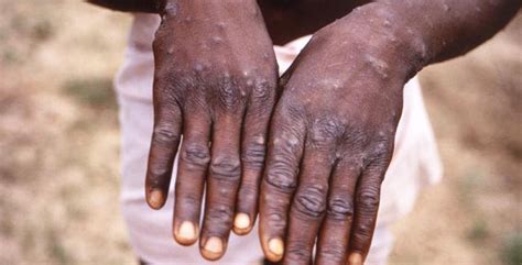 All You Need To Know About The Monkeypox Disease Public Health