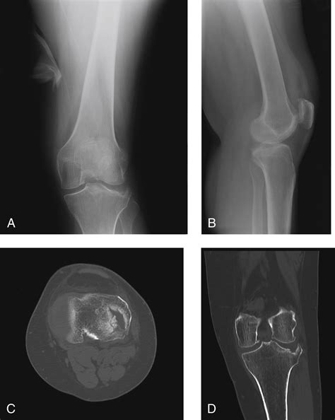 Open Reduction And Internal Fixation Of Tibial Plateau Fractures
