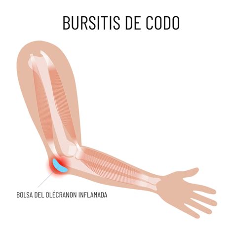 Bursitis de codo qué es causa síntomas y tratamiento Por Una Vida