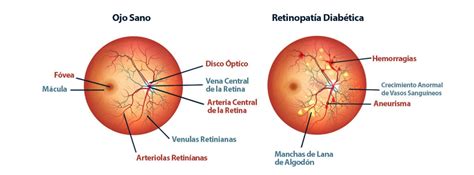 Retinopatía diabética Qué es síntomas causas y tratamiento