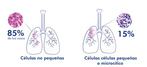 Cancer De Pulmon Tipos