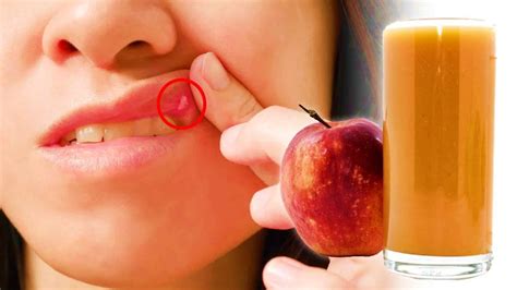 How To Get Rid Of A Canker Sore Fast Removing Canker Sore Apple Cider Vinegar Apple Canker