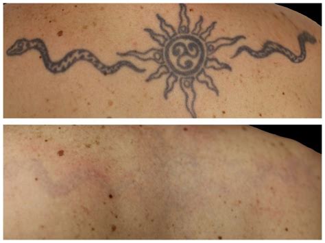 Tratado Gladys batería tatuajes quitados con laser antes y despues