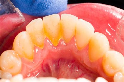 Qu Debes Saber Sobre La Placa Dental Instituto Integral Odondol Gico