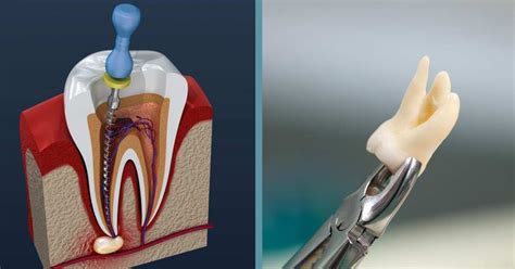 Root Canal Vs Tooth Extraction What To Expect Iqaluit Dental Clinic