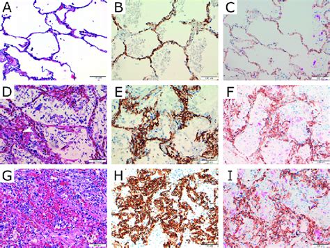 Vascular Patterns In Patients With COVID 19 A Normal Lung H E B