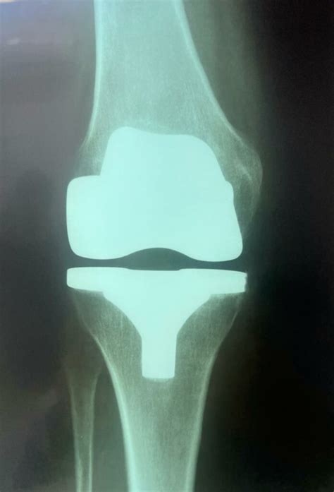 PRÓTESE NO JOELHO SAIBA MAIS SOBRE A ARTROPLASTIA
