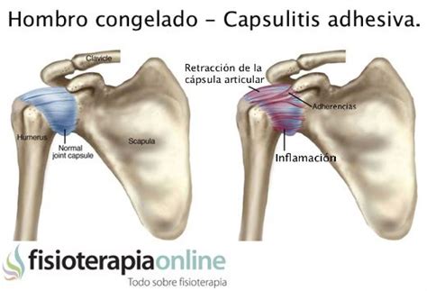 Hombro congelado o Capsulitis adhesiva Qué es causas síntomas