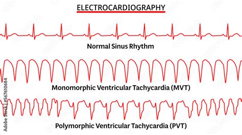 Set Of ECG Common Abnormalities Normal Sinus Rhythm Monomorphic VT
