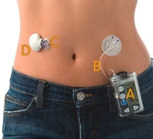 Continuous Blood Glucose Monitors Australia What Should A Diabetic S