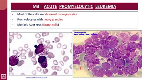 Hematology U L Fab Classification Of Aml Subtypes Youtube