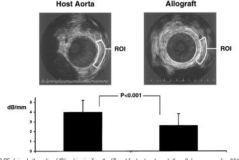 figure 2 from feasibility of in vivo intravascular ultrasound tissue characterization in the