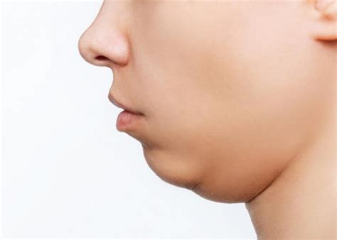 Catat Inilah 7 Cara Efektif Menghilangkan Double Chin