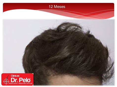 Injerto Capilar Con La T Cnica Fue Para Recuperar Cabello Con Aumento