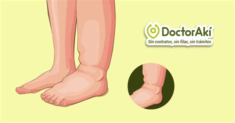 Piernas Hinchadas Qu Es Tipos Signos Y Causas L Doctorak