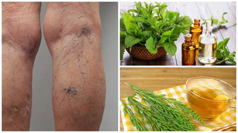 7 Remedios Caseros Para Tratar Las Varices