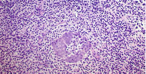 Salivary Gland Pathology Flashcards Quizlet
