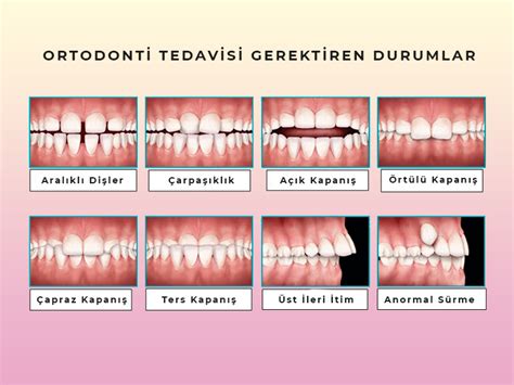 Ortodonti Tedavisi Nedir Ortodontik Tedavi Nasıl Uygulanır Net Diş
