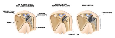 Mr Paul Jarrett Shoulder Arthritis Murdoch Orthopaedic Clinic