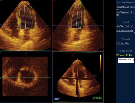 Lv Apical Mass Semashow