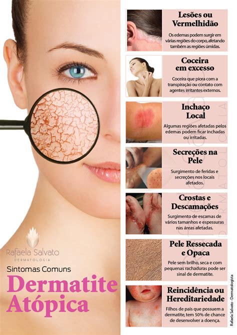 Dermatite Atópica