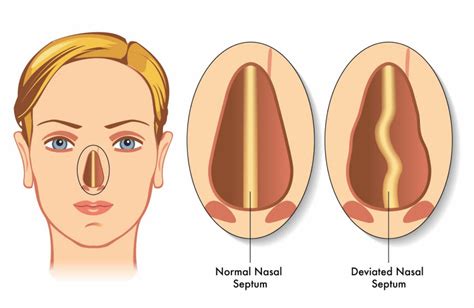 Deviated Septum Nose Job Uk Jamaal Kincaid