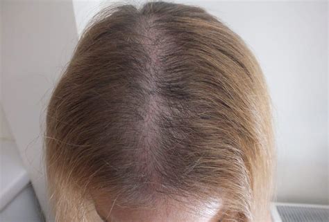Telogen Effluvium Hair Loss Doç Dr Ekrem Civas