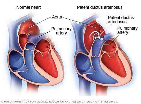Patent Ductus Arteriosus PDA Disease Reference Guide Drugs
