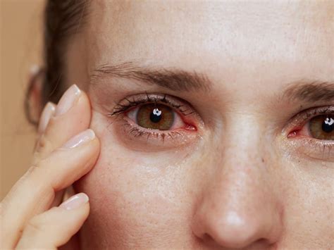 Tipos de Alergia nos Olhos Conheça as principais