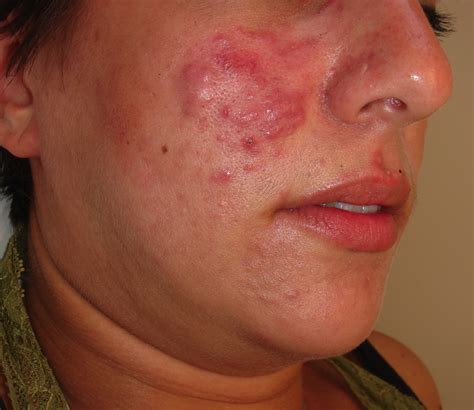 Erythema Nodosum Face