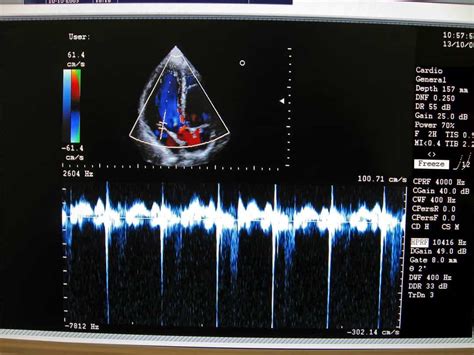 Qu Es Un Ecocardiograma Y Un Doppler Unidad M Dica