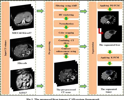 figure 1 from fuzzy c means based cad sytem for liver tumors segmentation from ct scans