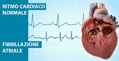 La Fibrillazione Atriale Proteggo Il Mio Cuore