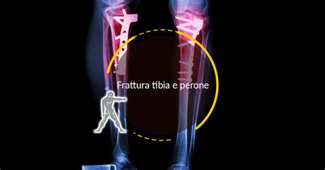 Frattura Tibia E Perone Guida Avanzata Ryakos Fisioterapia