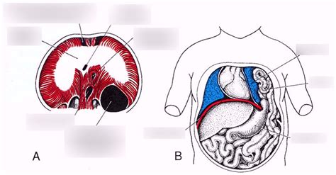 Congential Diaphragmatic Hernia Diagram Quizlet