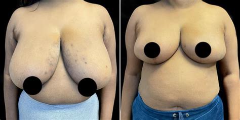 Breast Reduction Results Atlanta Before After