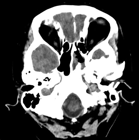 A Systematic Approach To The Interpretation Of CT Head