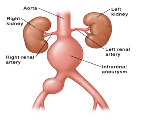 รายการ 98 ภาพ Abdominal Aortic Aneurysm อาการ ใหมทสด