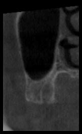 Elevación seno atraumática o transcrestal Perio Implant