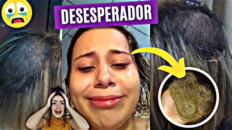 GRAVE QUEDA DE CABELO VEJA O QUE ACONTECEU ESSA MENINA QUE PERDEU