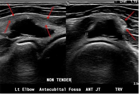 NEW CONTENT RADIOLOGY IMAGING IN ACUTE DISTAL BICEPS TEN Issuu