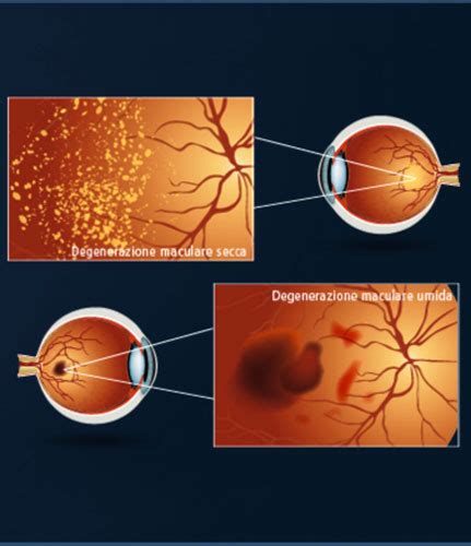 Maculopatia Retinica Degenerativa Aktivision