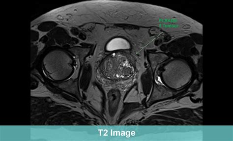 Prostate Cancer Mri Images