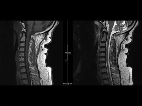 Cervical Spine Mri Labeled