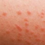 Pinprick Red Dots On Skin Not Itchy Pictures What Are These Tiny Red