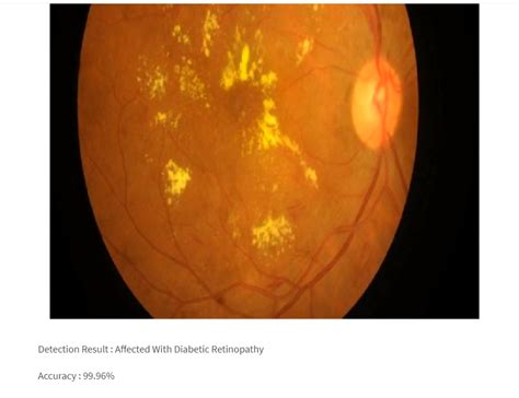 diabetic retinopathy detection classification matlab